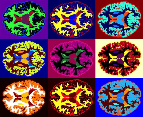 Stronger Link Between Ebv And Ms Brings Concrete Clinical Hope The Niche