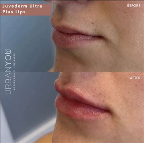Lip Filler Before And After Juvederm Lips Juvederm Lip Fillers