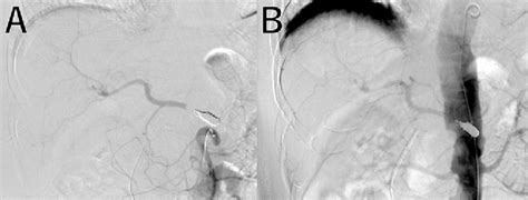 Figure 5 From Coil Embolization Of A Celiac Artery Pseudoaneurysm Under