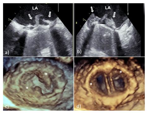 Endocarditis Vegetation