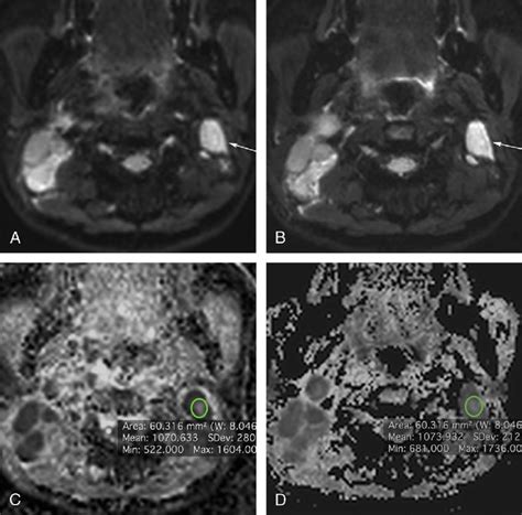 A 42 Year Old Male Patient With Diagnosed Npc And Bilateral Cervical Download Scientific