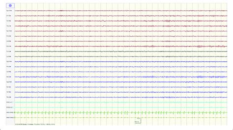 resolution of the burst suppression pattern and normalization of the