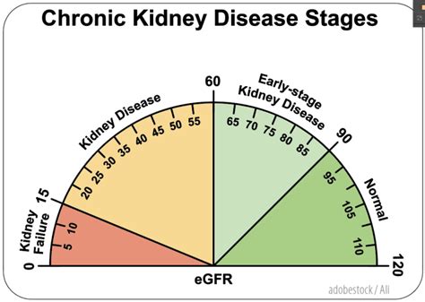 The Risky Business Of Coding Ckd And Esrd Aapc Knowledge Center