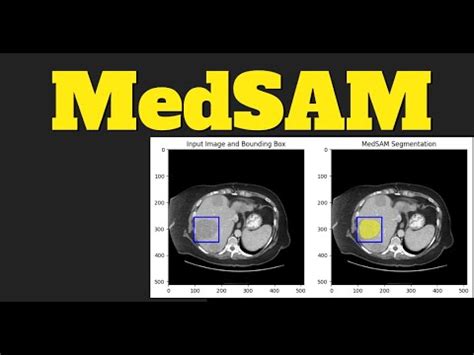 MedSAM Segment Anything In Medical Images Universal Medical Image Segmentation YouTube