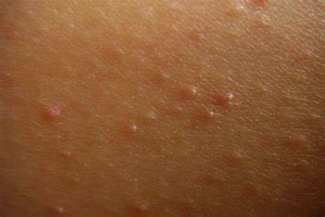 14 Causes Of A Pimple Like Rash