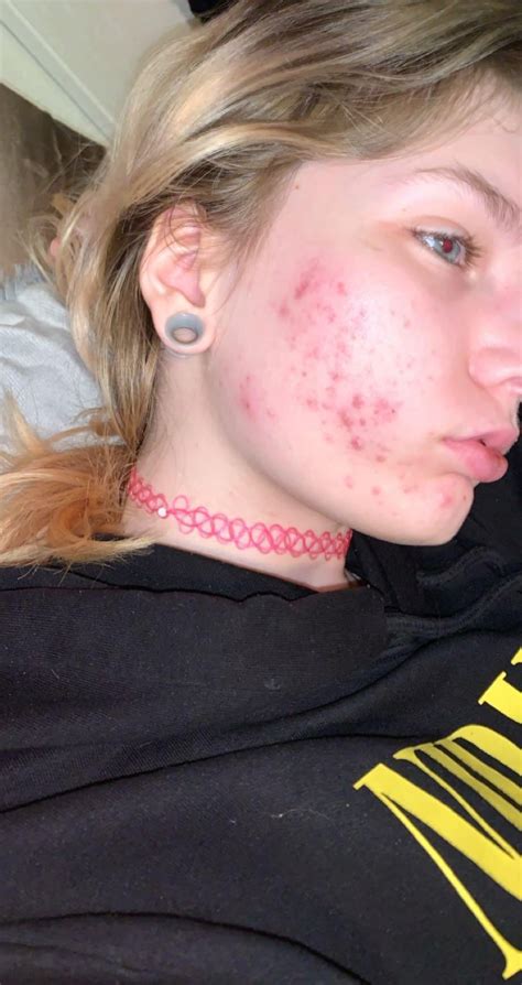 Tretinoin And Doxycycline 7 Month Progress ♡ R Acnescars
