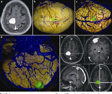Figure 2 From Application Of Multimodal Image Fusion Technology In Brain Tumor Surgical