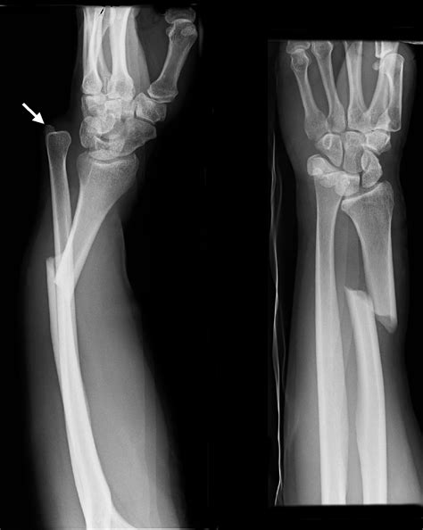 Fracture Wallpapers Video Game Hq Fracture Pictures 4k Wallpapers 2019