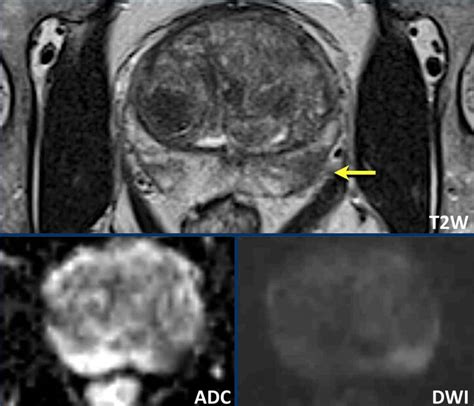 The Radiology Assistant Prostate Cancer Pi Rads V2 1