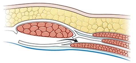 Incisional Hernia Repair What The Radiologist Needs To Know Ajr