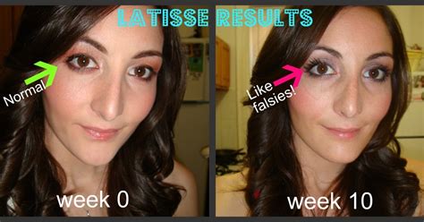 Prettied Up My Dramatic Results After Using Latisse For 10 Weeks