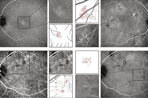 Punctate Hyperfluorescence Spot As A Common Choroidopathy Of Central