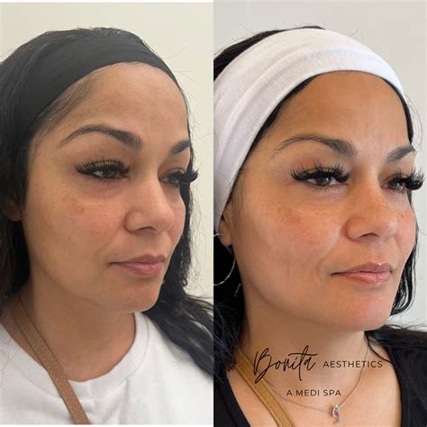 Morpheus Face Bonita Aesthetics Of Sacramento Morpheus Face Bonita Aesthetics Of Sacramento