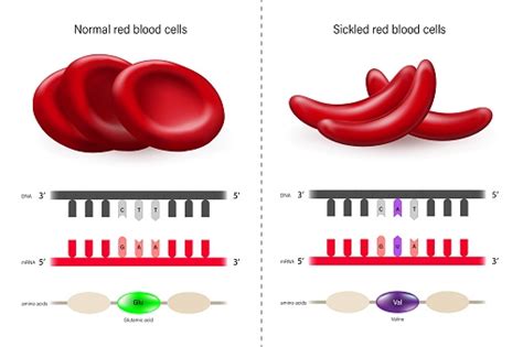 겸상 적혈구 질환 정상 적혈구와 겸상 적혈구 포인트 돌연변이 건강관리와 의술에 대한 스톡 벡터 아트 및 기타 이미지 건강