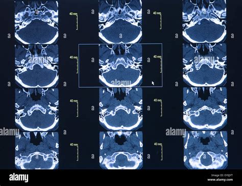 Brain Tumor Film Ct Scan Brain Hi Res Stock Photography And Images Alamy
