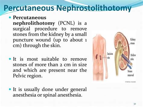 Nephrolithiasis Ppt
