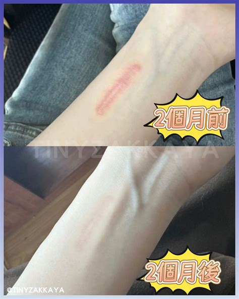 🇯🇵日本♥hisamitsu 久光小川令疤痕修復去疤貼 Hisamitsu Eclar Plaster Keloid Scar Remove