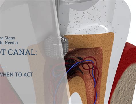 How Long Does A Root Canal Take Start To Finish Timeline Eastern Idaho Endodontics