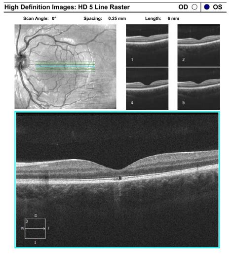 Oct Imaging Of The Left Eye With A Hd 5 Line Raster Depicts The Foveal Download Scientific