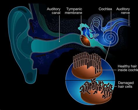 Sciencealert Tinnitus At Paul Maxwell Blog