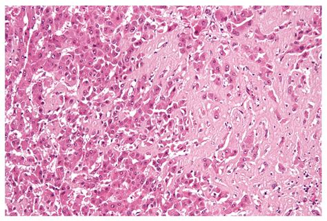 Watching Amyloid Form From Test Tubes To Tissues Faculdade De