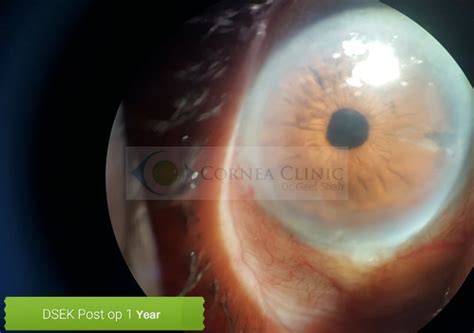 Dsaek And Dmek Keratoplasty Surgery In Ahmedabad Cornea Clinic
