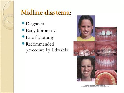 Leveling And Aligning In Orthodontics Ppt