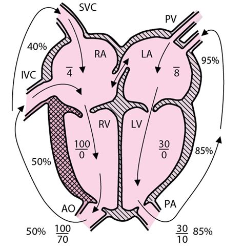 Imagedextro Transposition Of The Great Arteries Msd Manual