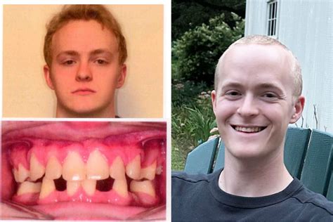 Best Practices For Treating Your Ectodermal Dysplasia Teeth Nfed
