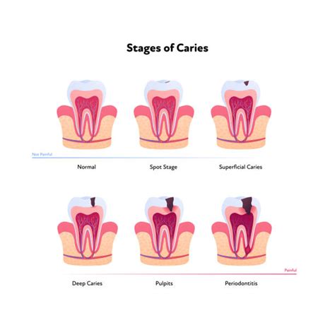 Caries Stages