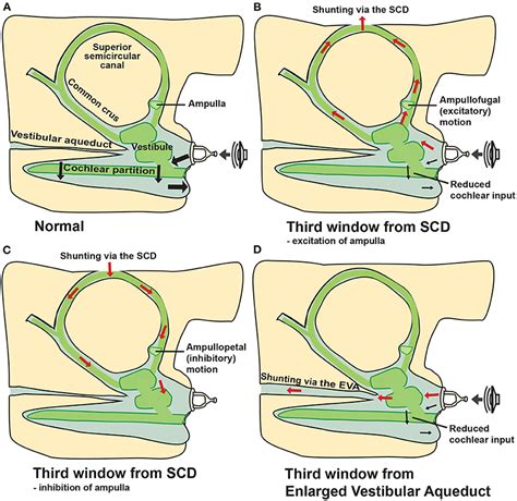 Semicircular Canal Dehiscence Syndrome Frontiers Manual