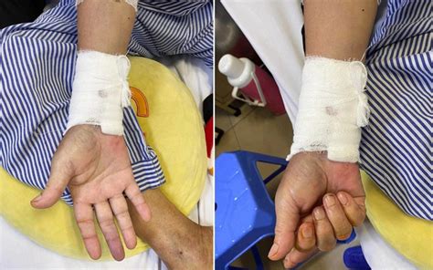 Quảng Ninh phẫu thuật cấp cứu lấy huyết khối thành công cho bệnh nhân bị tắc động mạch quay