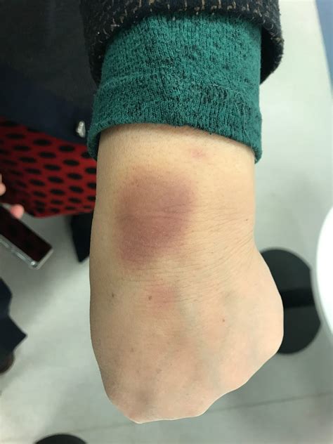 Drug Eruptions With Cases Fixed Drug Eruption And Dress Syndrome By Drseymahandan Ailenizin