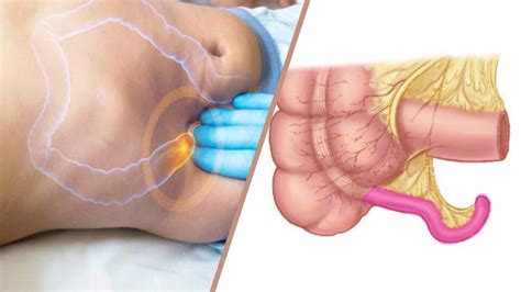 What Does The Appendix Do GynecolOncol