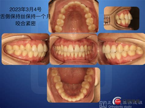 我的2023年之腭侧种植支抗联合tpa绝对支抗解除重度拥挤 毛玲mao的博客 Kq88口腔博客