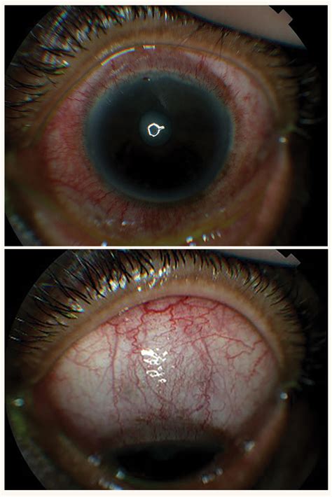 Lesson Distinguishing Episcleritis From Scleritis In Optometric Practice