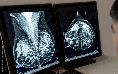 A Doctor Radiologist In A Hospital Mammography Analysis Room Reading X