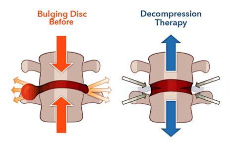 Trigger Point Injections In Sinking Spring And Reading Pa Smith