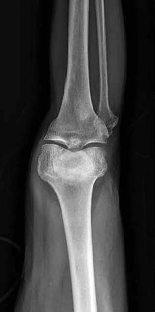 Radiographs Show Kellgren Lawrence Grade 2 Osteoarthritis Of The Left