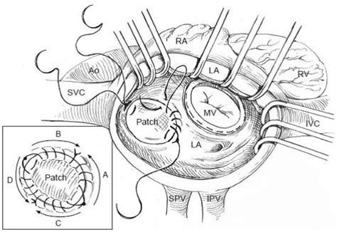 Occlusion Of The Laa Orifice With A Biomatrix Patch Cormatrix Ecm Download Scientific Diagram