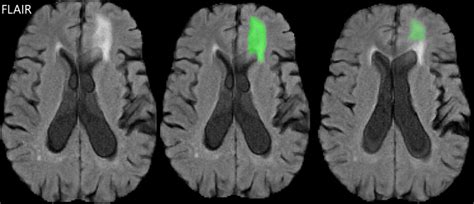 Common Errors Expected From Automated Segmentation Of Meningioma