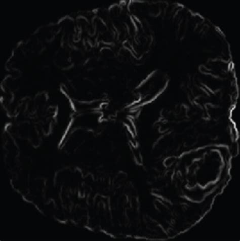 Samples From Each Class Of Brain Tumors In The Neutrosophic Domain A Download Scientific