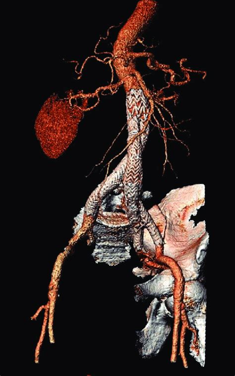 Ballerina Limb Configuration Helps To Optimize Hemodynamic Forces And