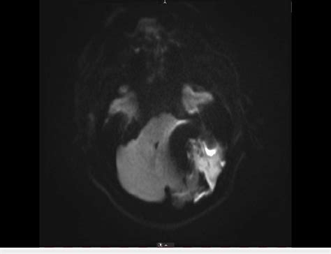 Preoperative Mri Dwi Sequence Showing Diffusion Restriction Of The