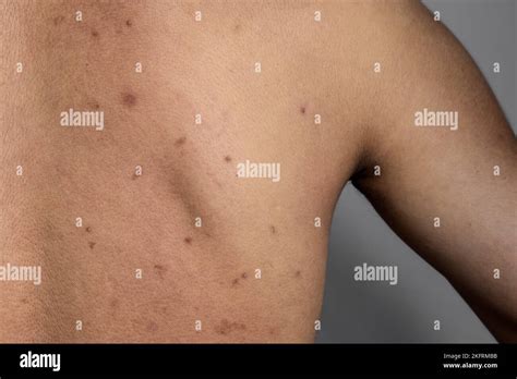 Black Spots Pimples Acne And Scars On The Back Of Asian Myanmar Man