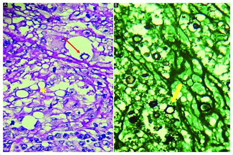 Lymph Node Biopsy A Hematoxylin Eosin He Stain 400x Chronic Download Scientific Diagram