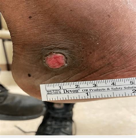 Vegetative Pyoderma Gangrenosum Of The Right Lower Extremity Measuring Download Scientific