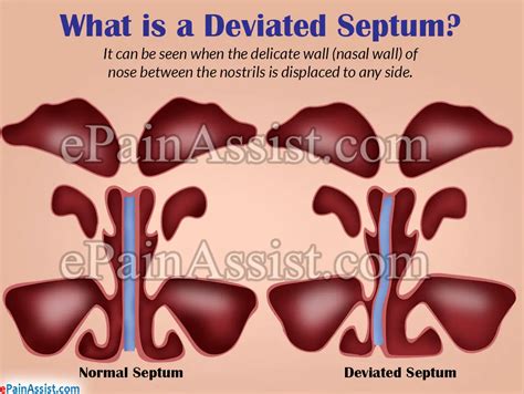 Septum Diagram