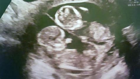 Twin Ultrasound 12 Weeks Dating And Chorionicity Scan About Twins