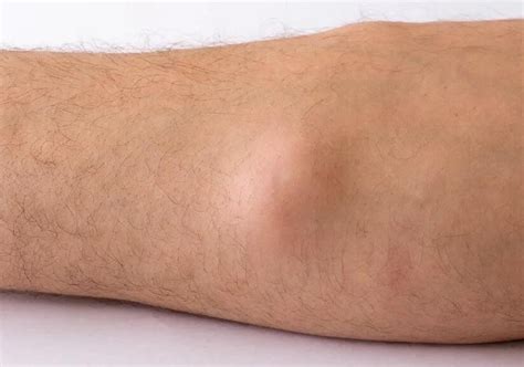 Lipoma Treatment Fatty Tumors Without Surgery